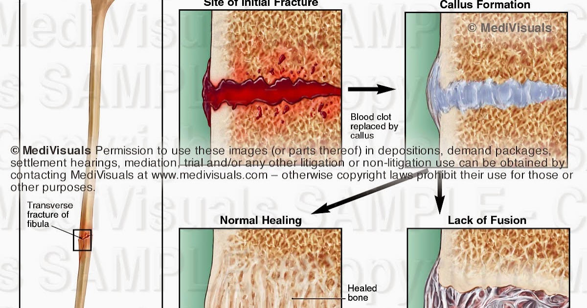 The Medical Legal Exhibit Expert Blog: Complications Associated with ...