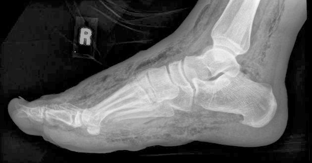 Tecnicos Radiologos: Pie diabético: hallazgos en Diagnóstico por Imagen ...