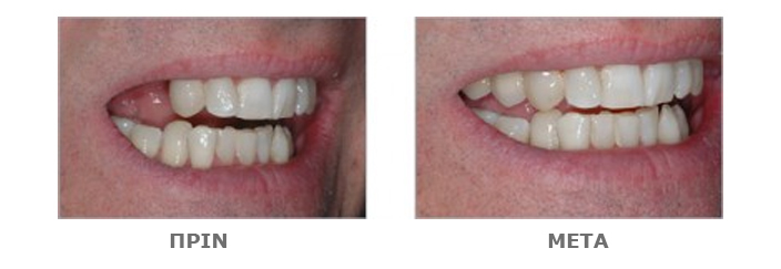 ΕΜΦΥΤΕΥΜΑΤΑ ΔΟΝΤΙΩΝ DENTAL IMPLANTS