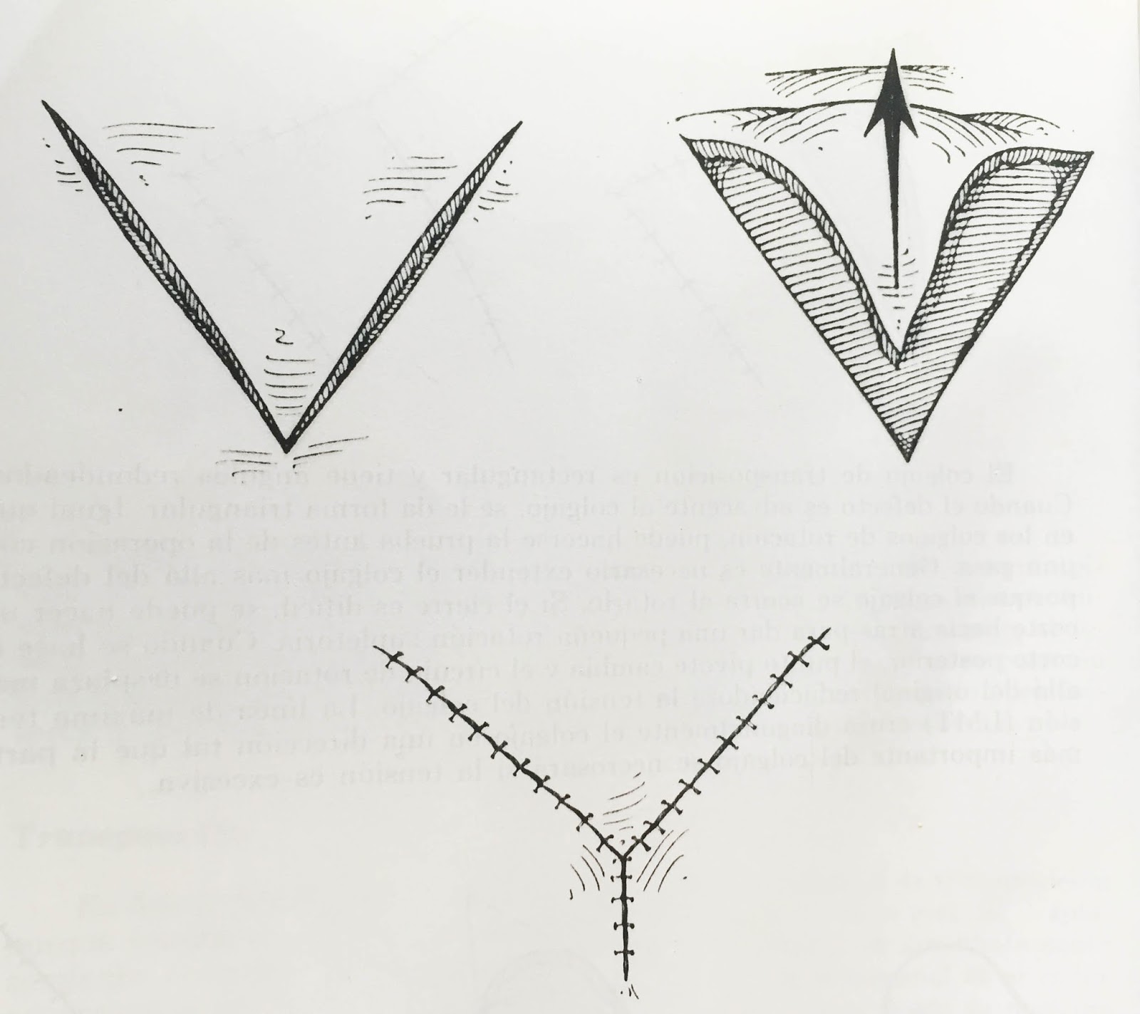 Curso de Cirugía Plástica CiruplasMedia: Colgajos