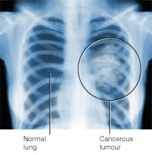 Health Information Today: Respiratory Distress Syndrome (RDS)