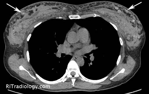 RiT radiology: Silicone Granulomas