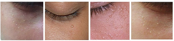 14 Home Remedies To Remove Milia (Milk Spots)