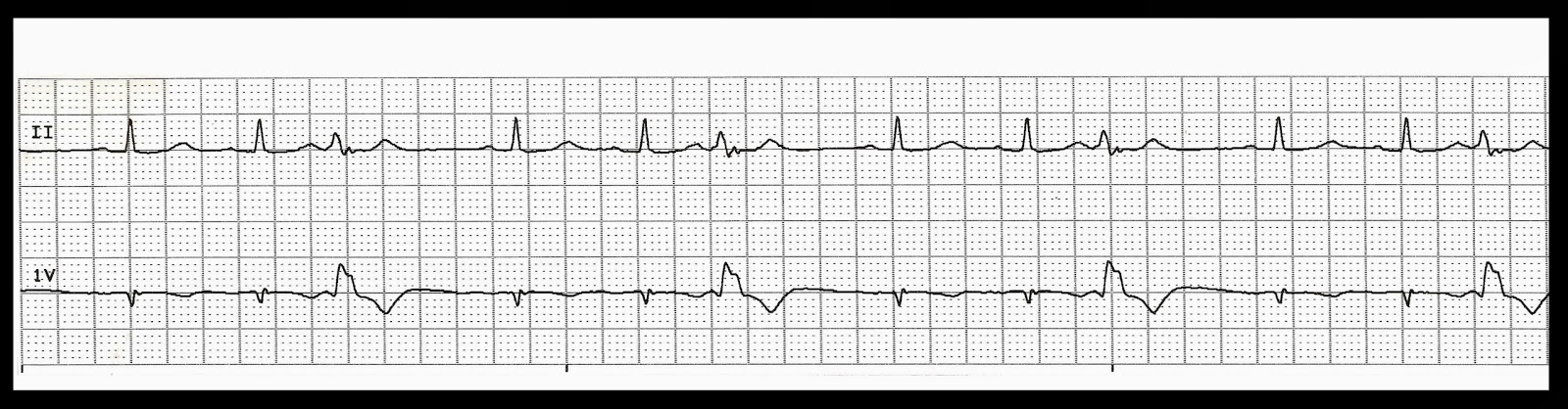 Float Nurse: Practice Rhythm Strips 287