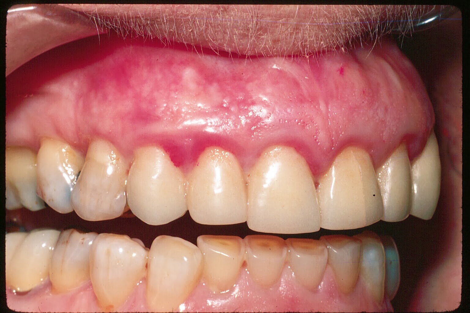 Dr. Robert G. Tupac: Prosthodontics: February 2014