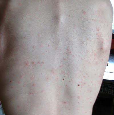 An Apel a Day: Pityriasis Rosea
