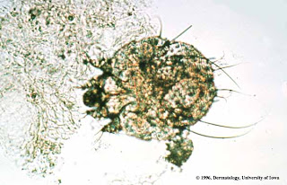 PetuaSihat: Petua Elak Scabies(Kudis Buta)