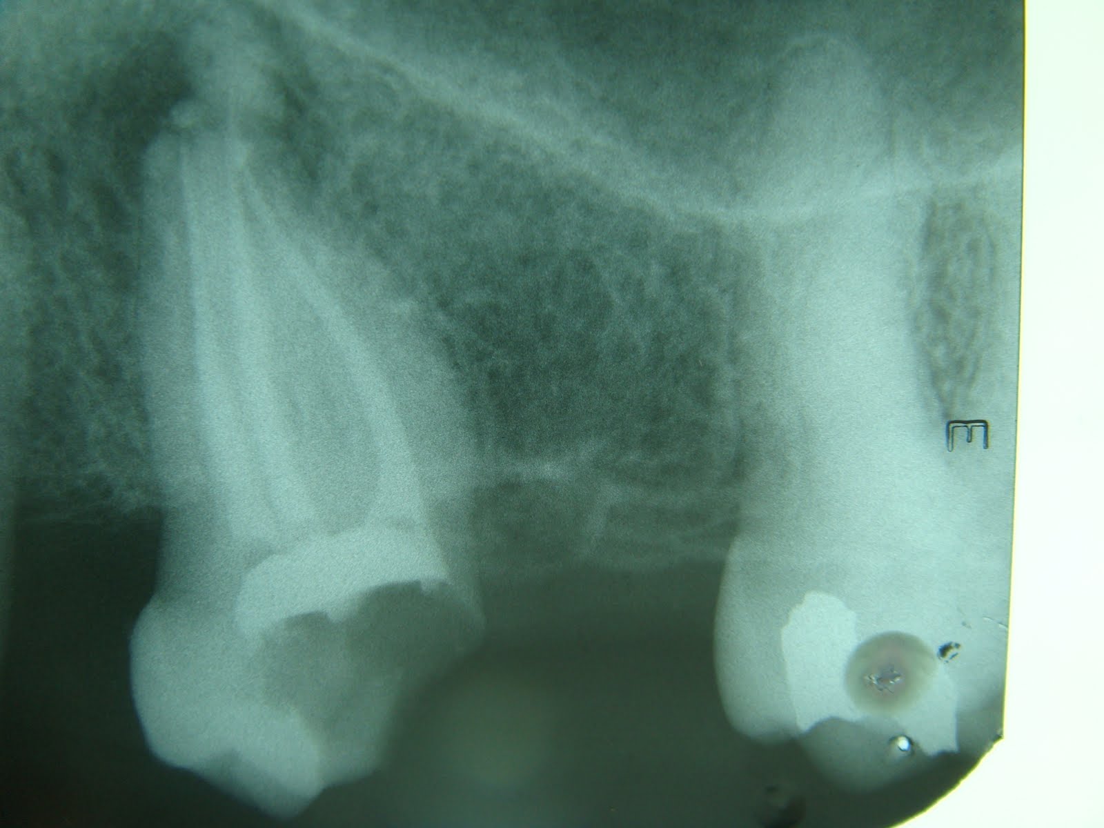 VENTURINI ODONTOLOGIA: CANAL EM DENTE DO SISO ? QUANDO FAZER? QUANDO ...