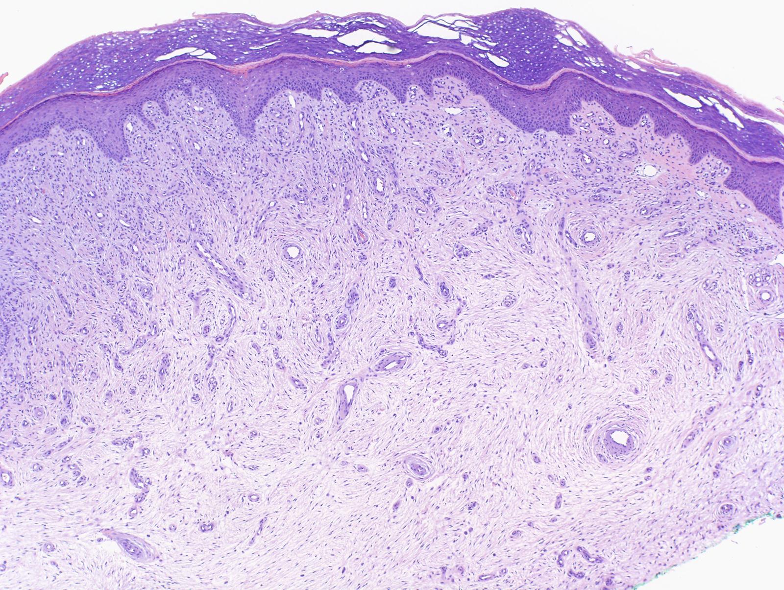 VIRTUAL GRAND ROUNDS IN DERMATOLOGY 2.0: Superficial Acral Fibromyxoma