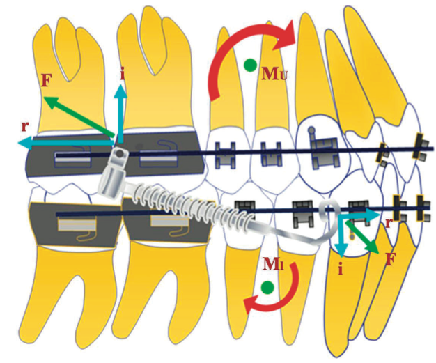 ORTODONTIA CONTEMPORÂNEA: Mini-implantes vs aparelhos funcionais fixos ...