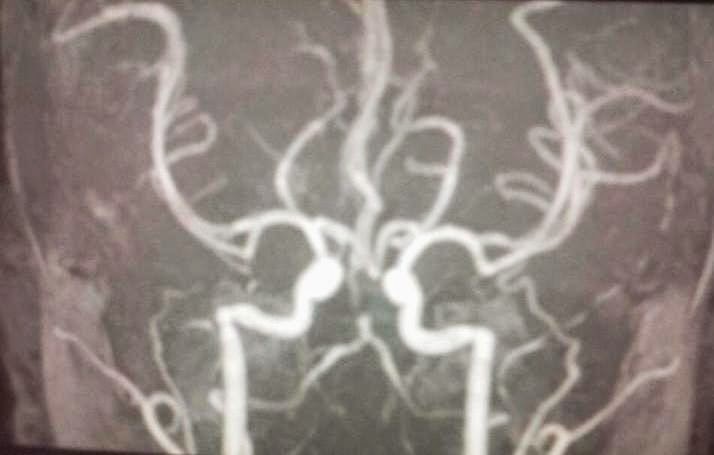Basilar Fenestration-MRA - Sumer's Radiology Blog