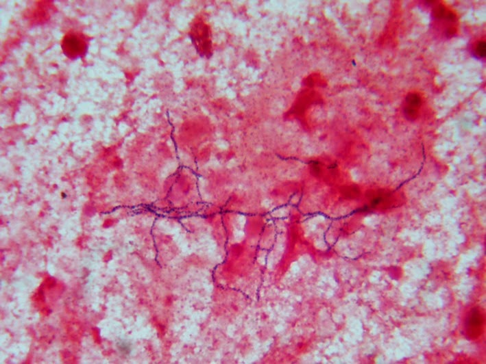 Medical Treatment Pictures-for Better Understanding: Nocardiosis
