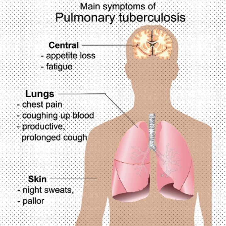 Tuberculosis / Pulmonary Tuberculosis / Lung Tuberculosis /TB | THE NEW ONE