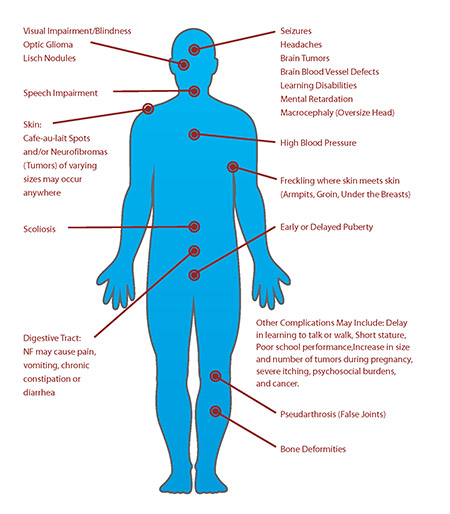 Syahidah Ishak - Acoustic Neuroma: Brain tumour?..Spinal tumour ...