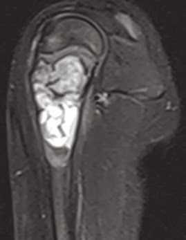 RADIODIAGNOSIS - IMAGE COLLECTION: SIMPLE BONE CYST