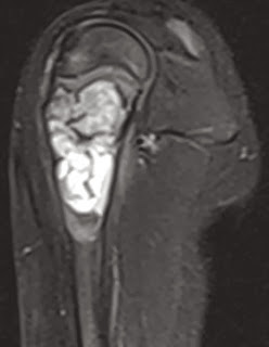 RADIODIAGNOSIS - IMAGE COLLECTION: SIMPLE BONE CYST