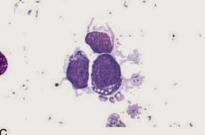 FICHERO DE HEMATOLOGIA: LLA - L3 BLASTOS MUY GRANDES