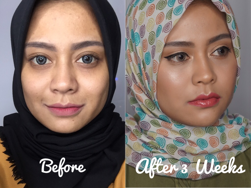 CARA MEMBUAT WAJAH JADI TIRUS DENGAN FILLER DAGU & BOTOX V SHAPE DI ...