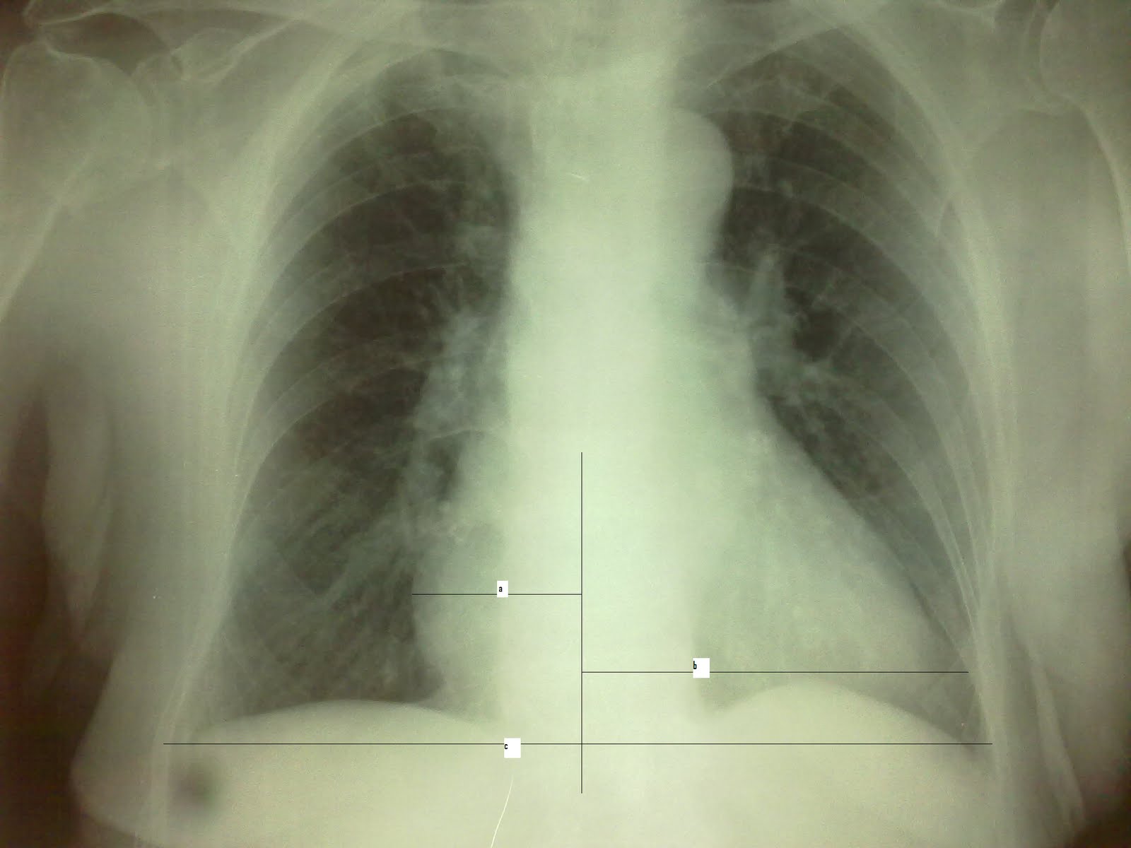 CLINICA DE GERIATRIA ON-LINE: CARDIOMEGALIA EN EL ANCIANO