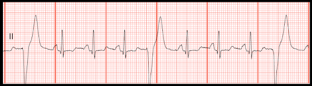Various Quadrigeminal PVCs