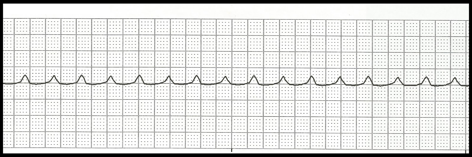EKG Rhythm Strip Quiz 108