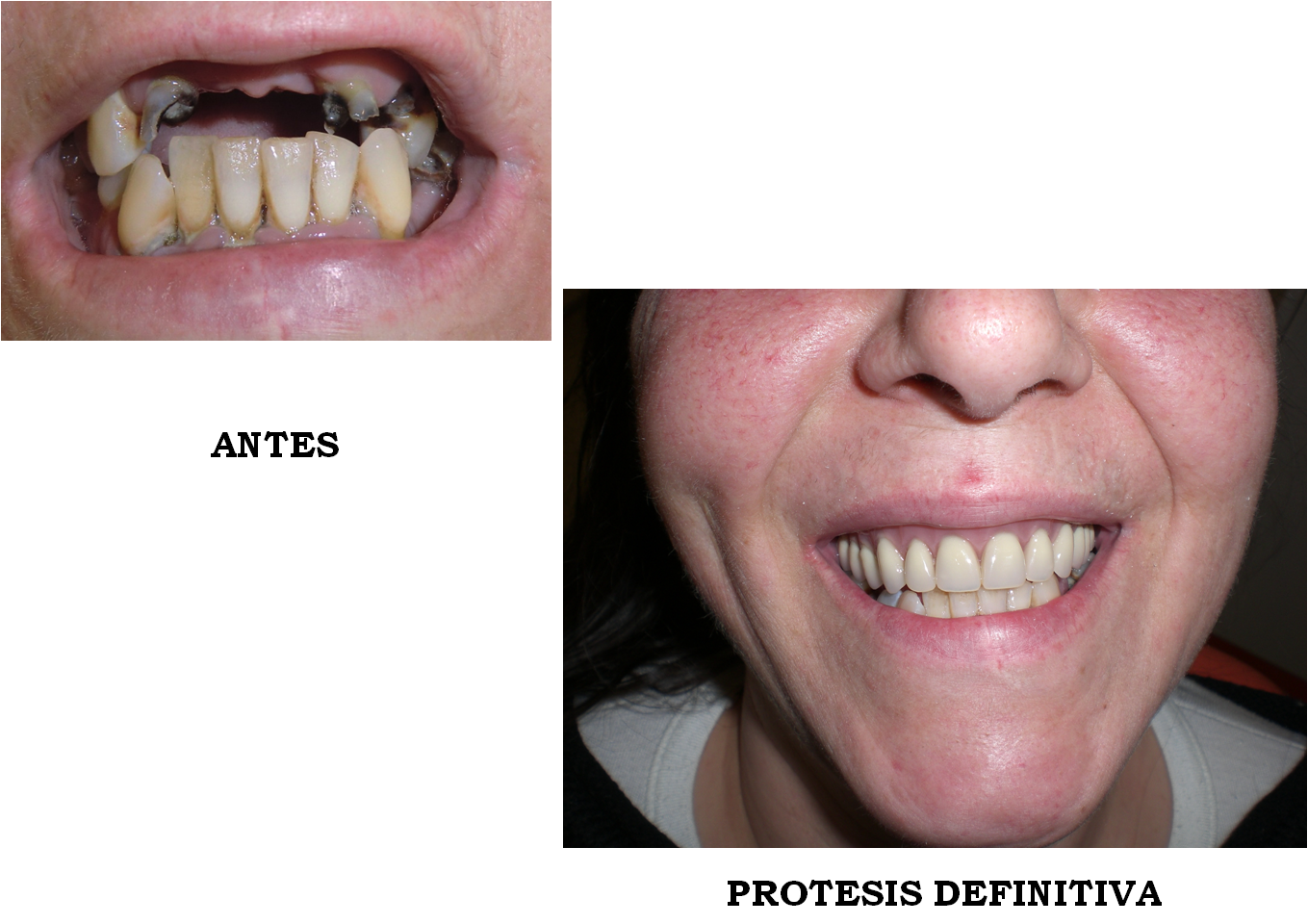 Dra Beatriz Dominguez Casos Clínicos : CASOS DE PRÓTESIS TOTALES