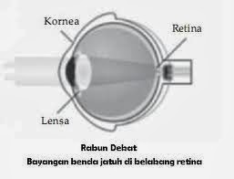 Macam-macam Penyakit Mata | Blog Arief Muliawan