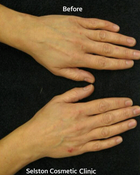 Selston Cosmetic Clinic: Dermal Filler Restores Volume in Ageing Hands ...
