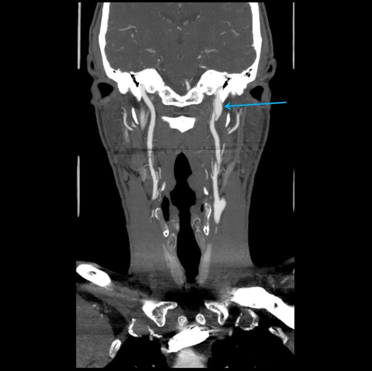 The Pump And The Tubes Carotid Dissection The Pump And The Tubes Carotid Dissection