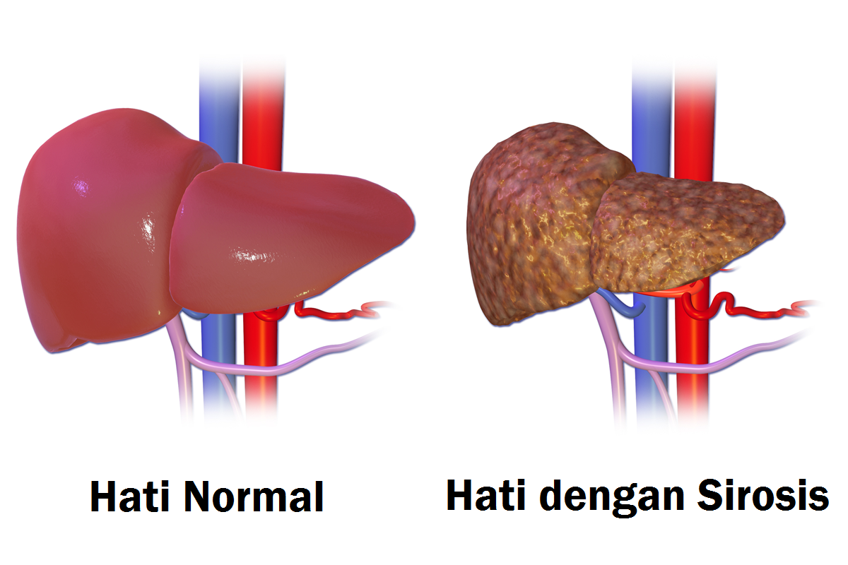 Sirosis Hepatis ~ Informasi Kedokteran Dan Kesehatan
