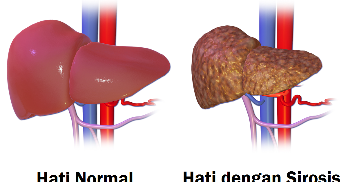 Sirosis Hepatis ~ Informasi Kedokteran Dan Kesehatan