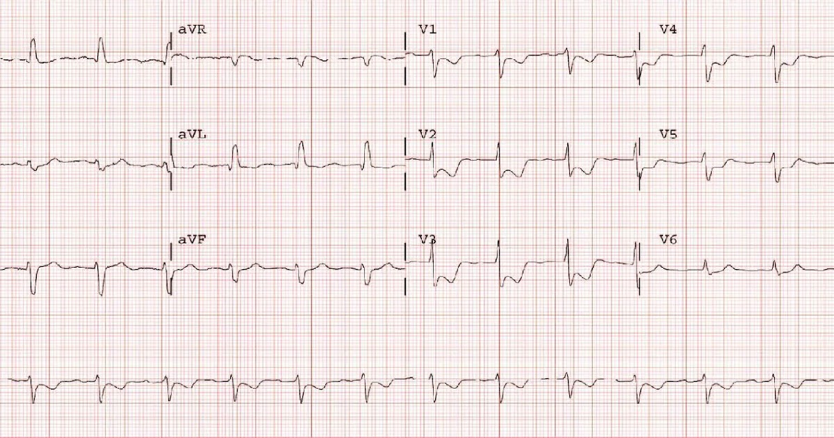 Study Medical Photos: Acute Posterior Myocardial Infarction - ECG