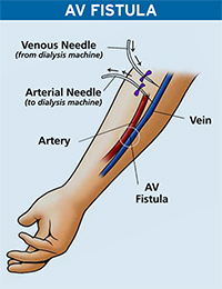 treatment for kidney disease: How to Protect the IAVF(arteriovenous ...