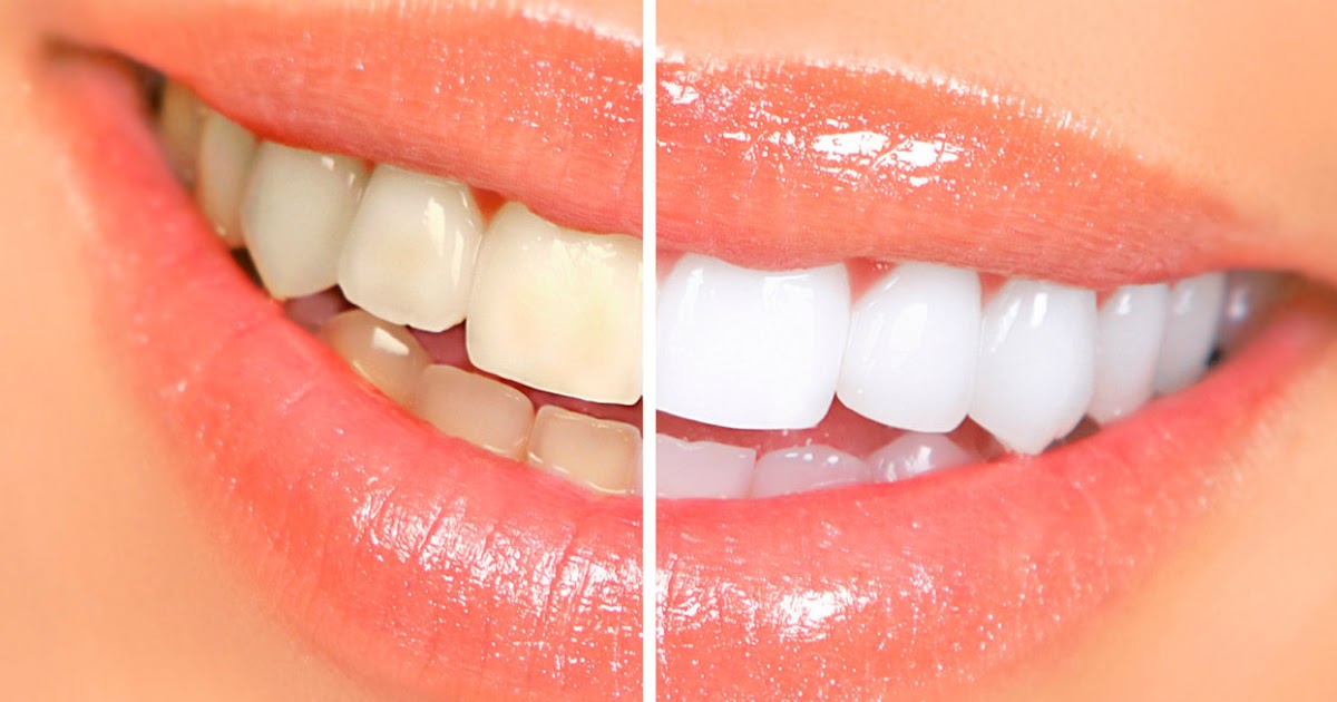 Como Tener Dientes Mas Blancos en Casa Blanqueamiento Dental