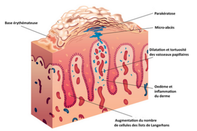 psoriasis: Psoriasis