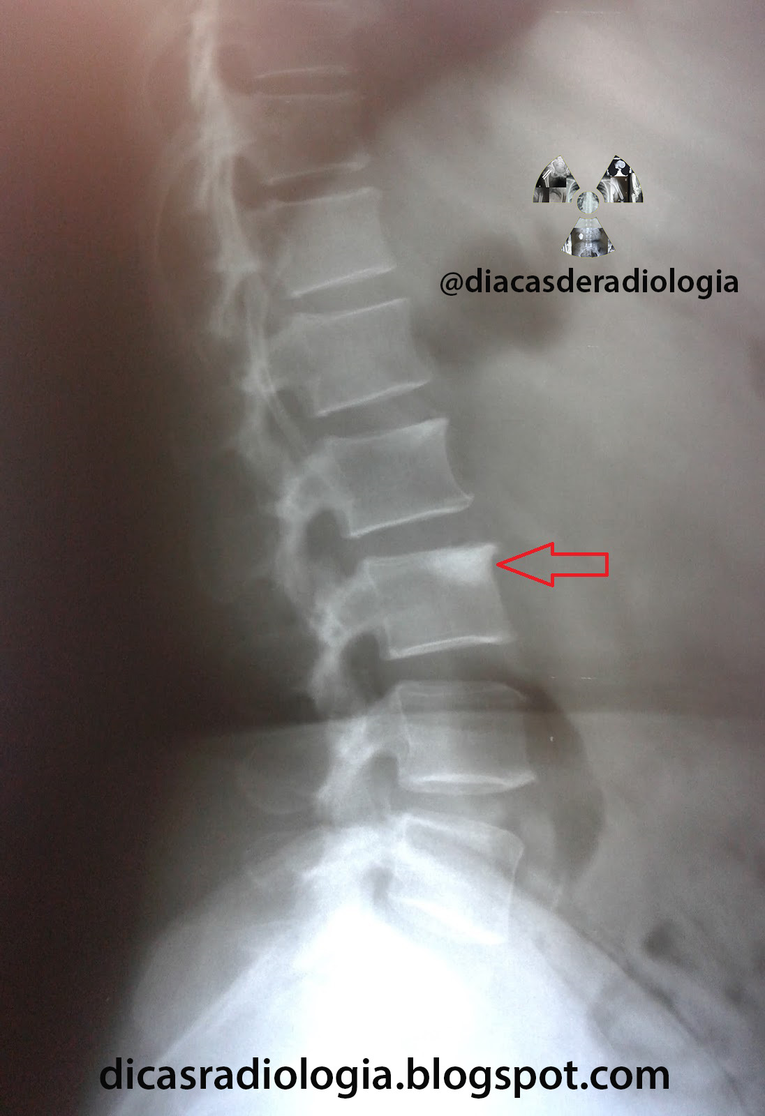 Manchas Pretas No Raio X Da Coluna - RETOEDU