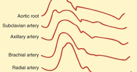 Pulsus alternans Definition, Symptoms, Causes, Treatment - Health Care ...