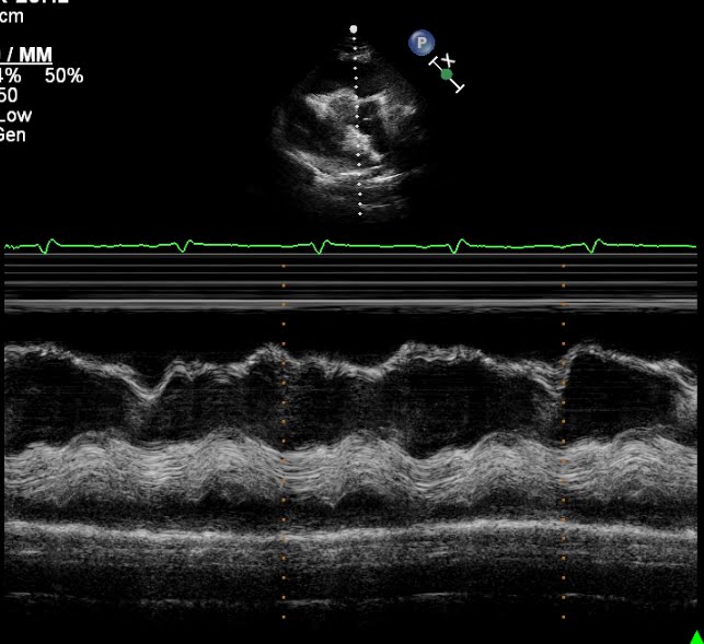 Pedi cardiology: Echo features of tamponade