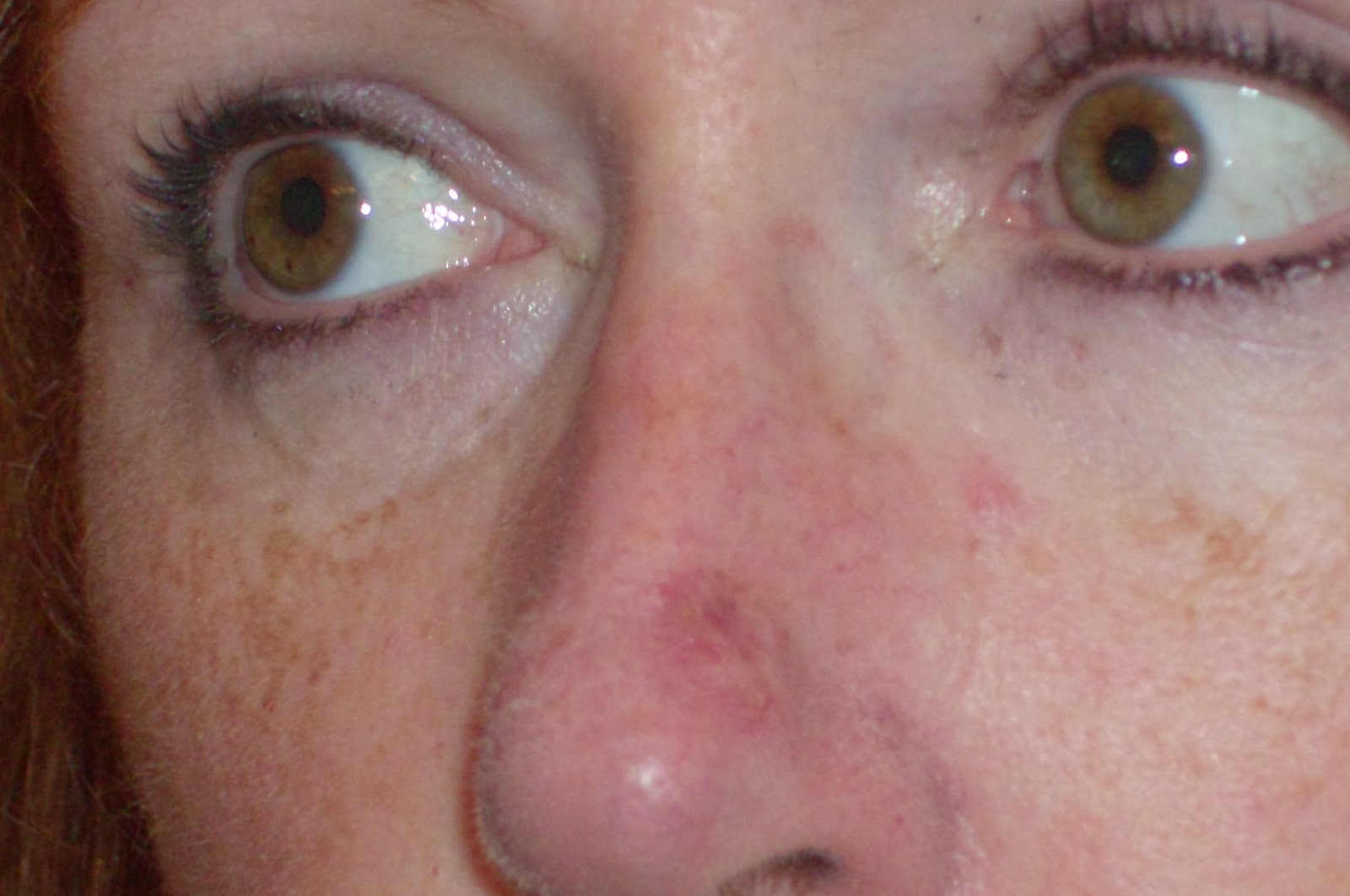 Bouton nez cancer - cribhaa91verptrac