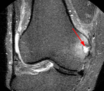 Radiology Pearls: Infrapatellar (Hoffa's fat pad) ganglion cyst