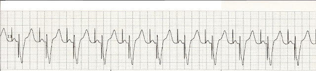 EKG Rhythm Strip Quiz 14
