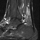MRI Musculo-Skeletal Section: Achilles peri tendonitis - MRI