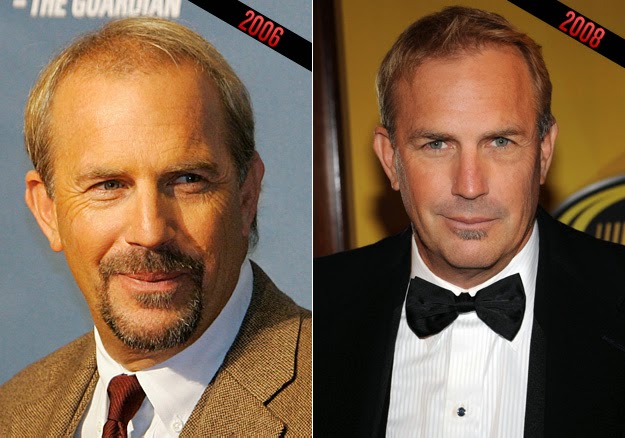 Kevin Costner Hair Transplant