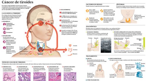 Dr. Tiroides Managua: Cáncer de tiroides