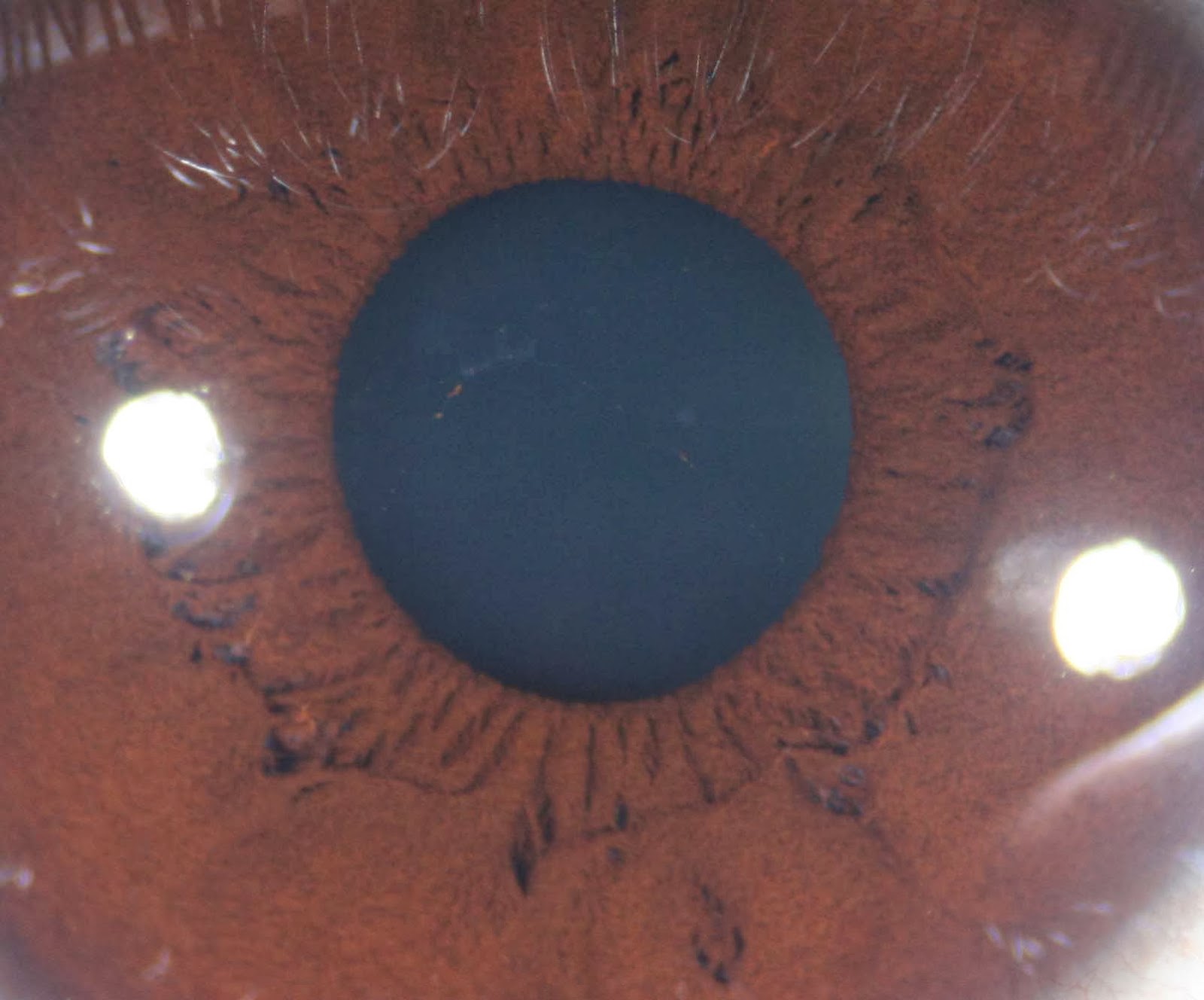 Modern & Multidimensional Iridology: Crypts at Pupillary Zone ...