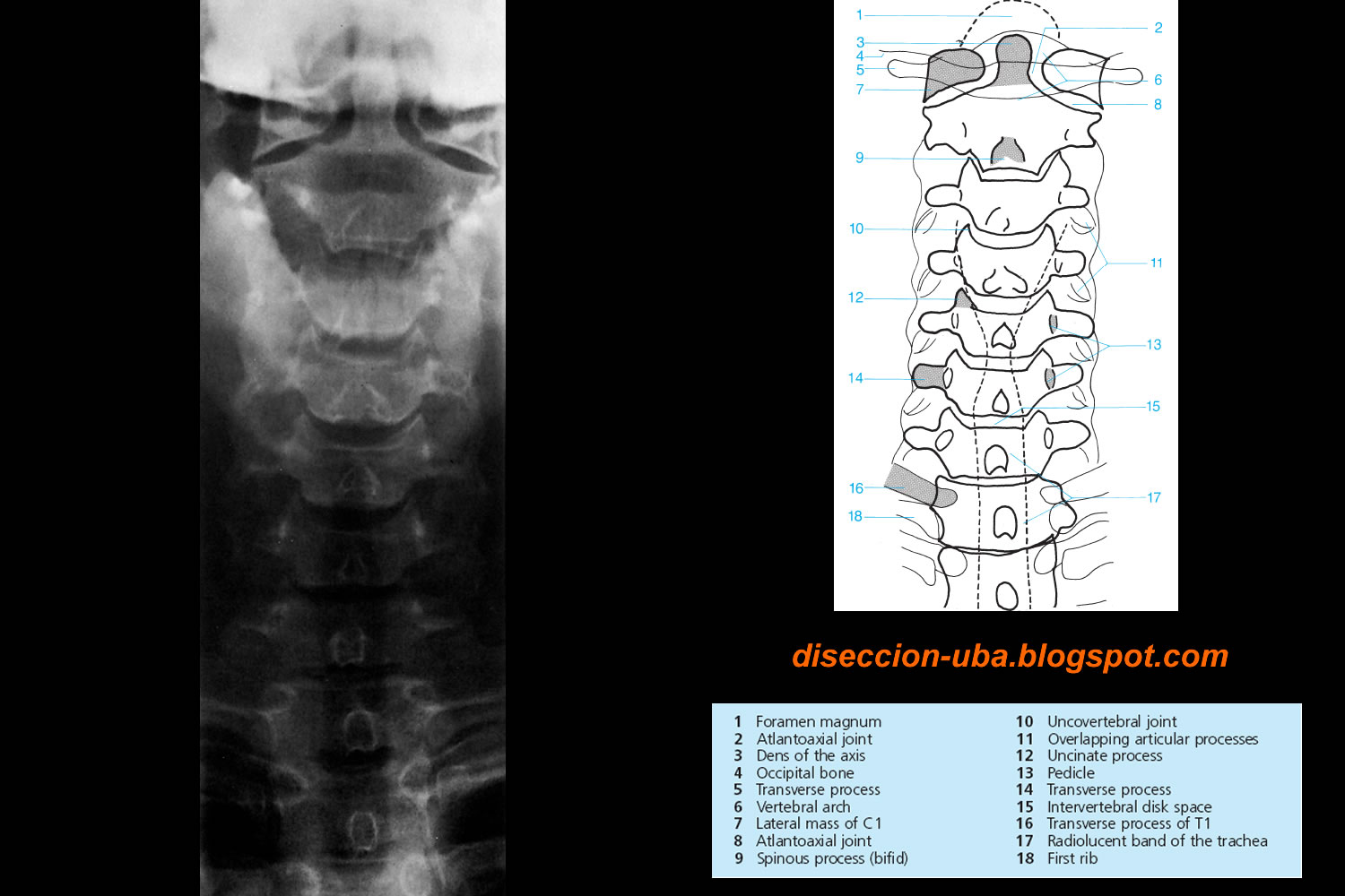 rx: Rx columna cervical anteroposterior