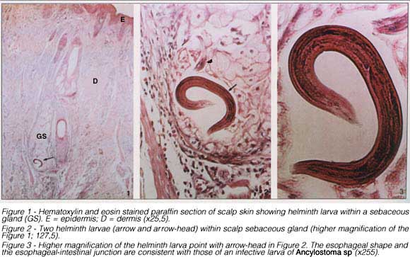 Asuhan keperawatan Teori Helminthiasis Lengkap - askep