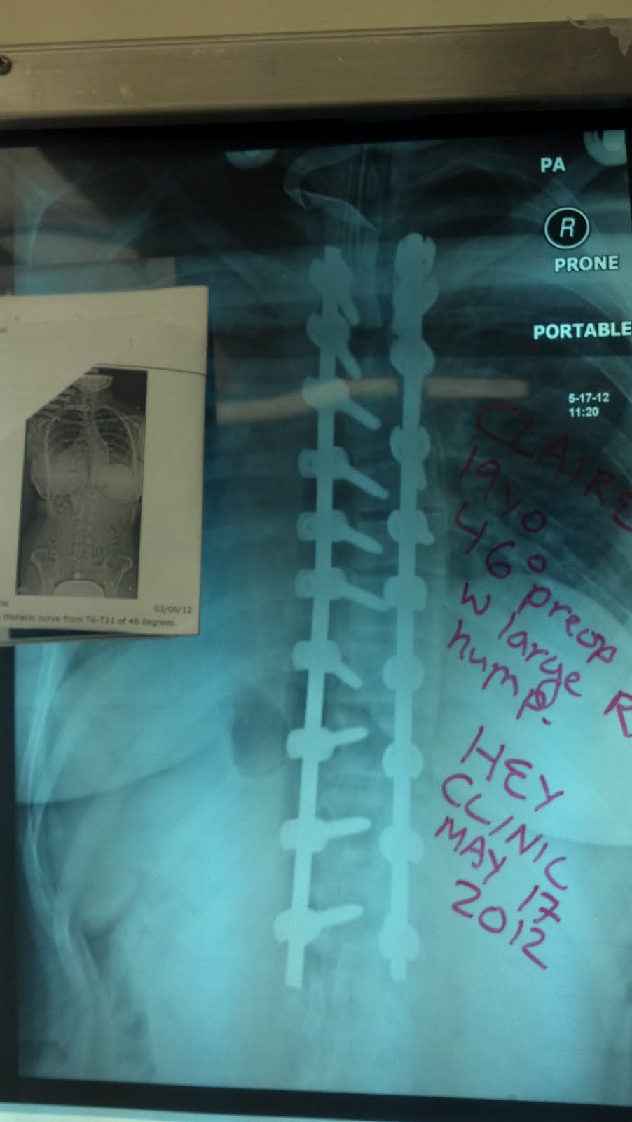 19 yo young lady w 46 degree r thoracic adolescent idiopathic scoliosis ...