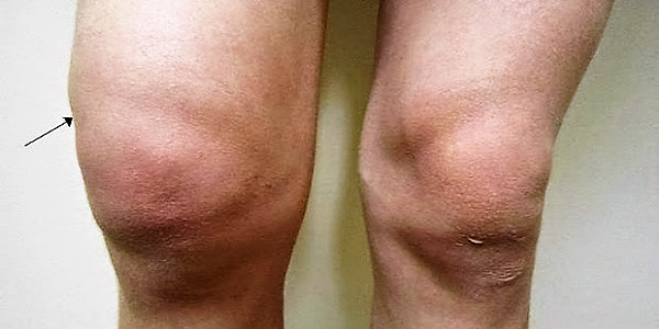 A P C S: Natural Simple Way To Get Rid Of Water On Your Knee