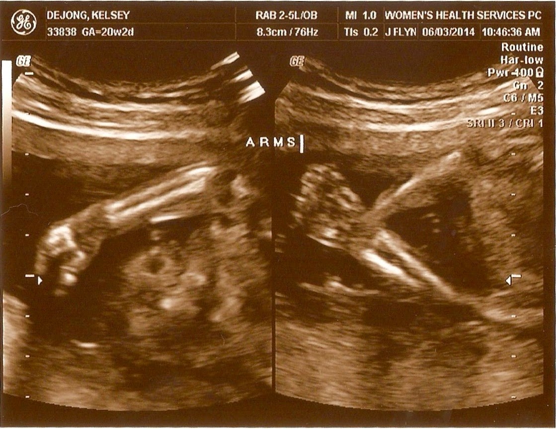 20 week ultrasound. ~ A Day with the De Jongs